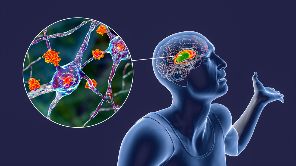 Breakthrough in treatment of Huntington's disease