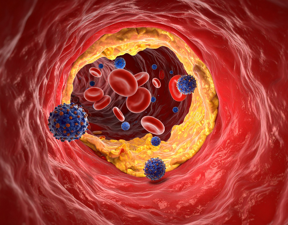 Nanoparticles shrink arterial plaque in new study